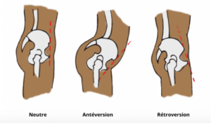 La rétroversion du bassin en yoga, une solution magique
